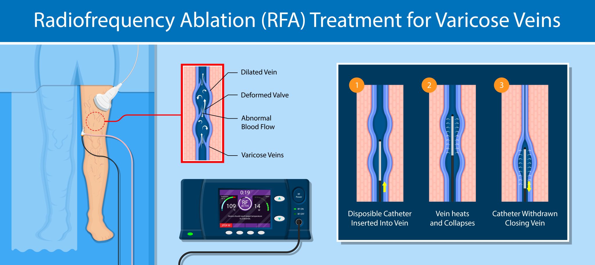 Radio Frequency Ablation (RFA) - Heart & Leg