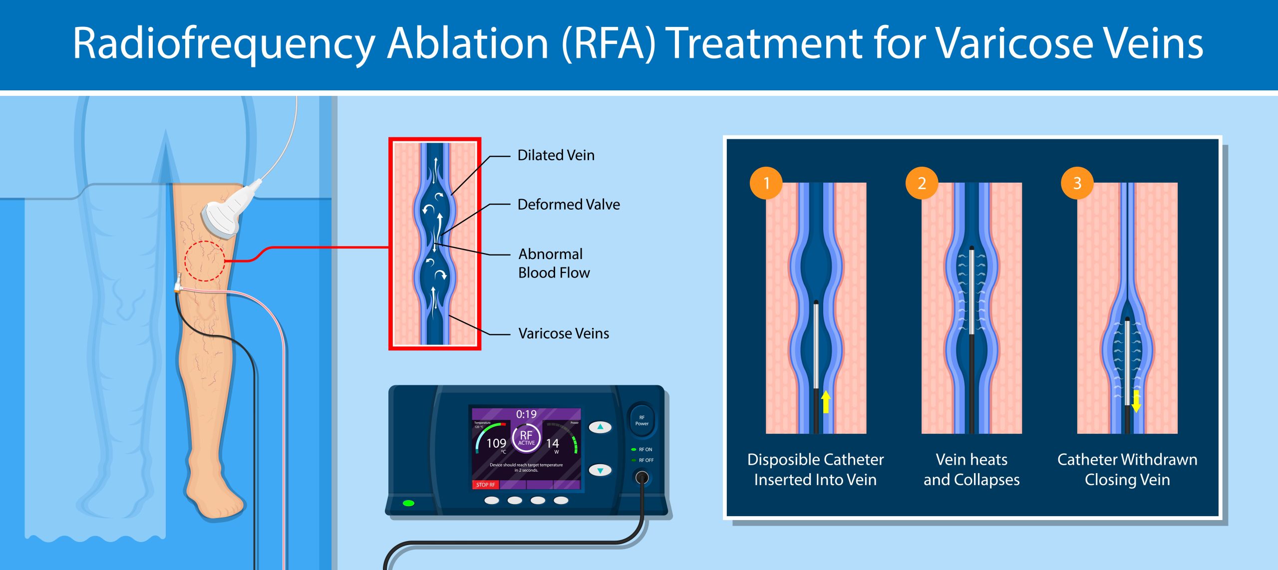 Radio Frequency Ablation (RFA) - Heart & Leg