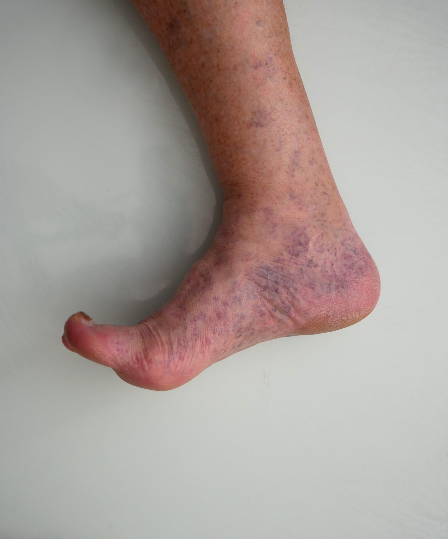 Skin Discoloration - Heart & Leg