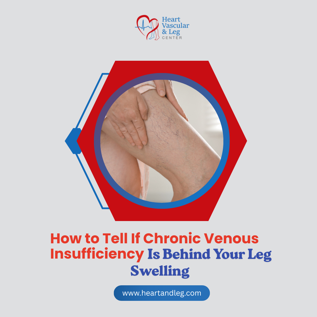 How to Tell If Chronic Venous Insufficiency Is Behind Your Leg Swelling